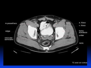 TAC de Abdomen y pelvis.pdf