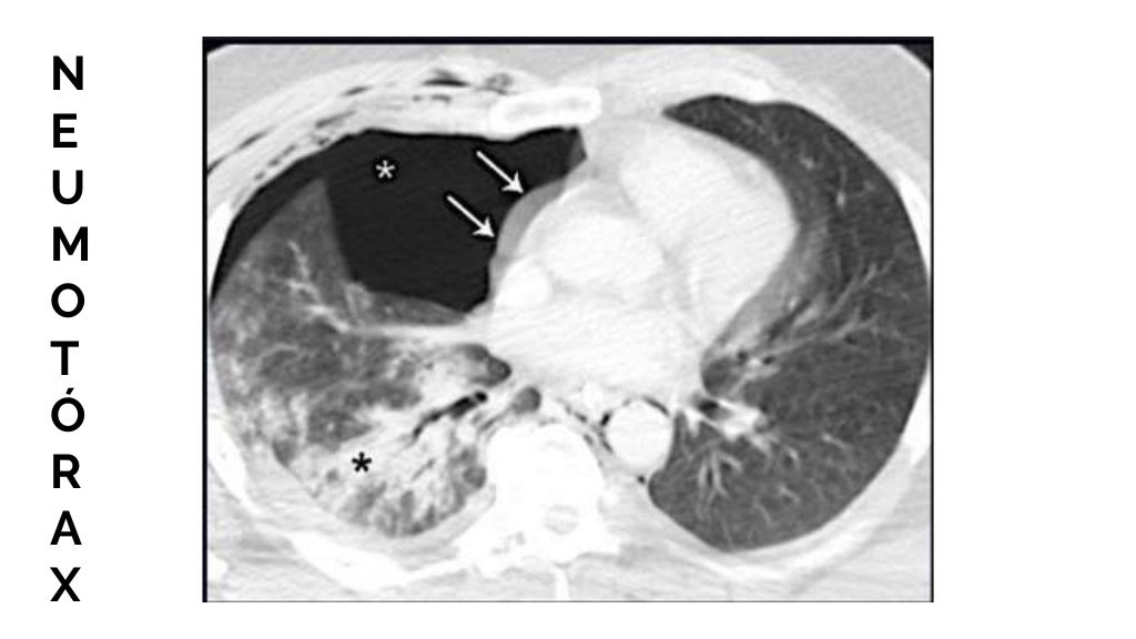 Tac Torax Patron Nodular