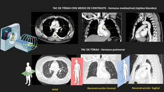 TAC DE TÓRAX diapositivas medicina uce medicina ll | PDF