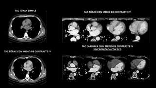 TAC DE TÓRAX diapositivas medicina uce medicina ll | PDF