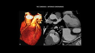 TAC DE TÓRAX diapositivas medicina uce medicina ll | PDF