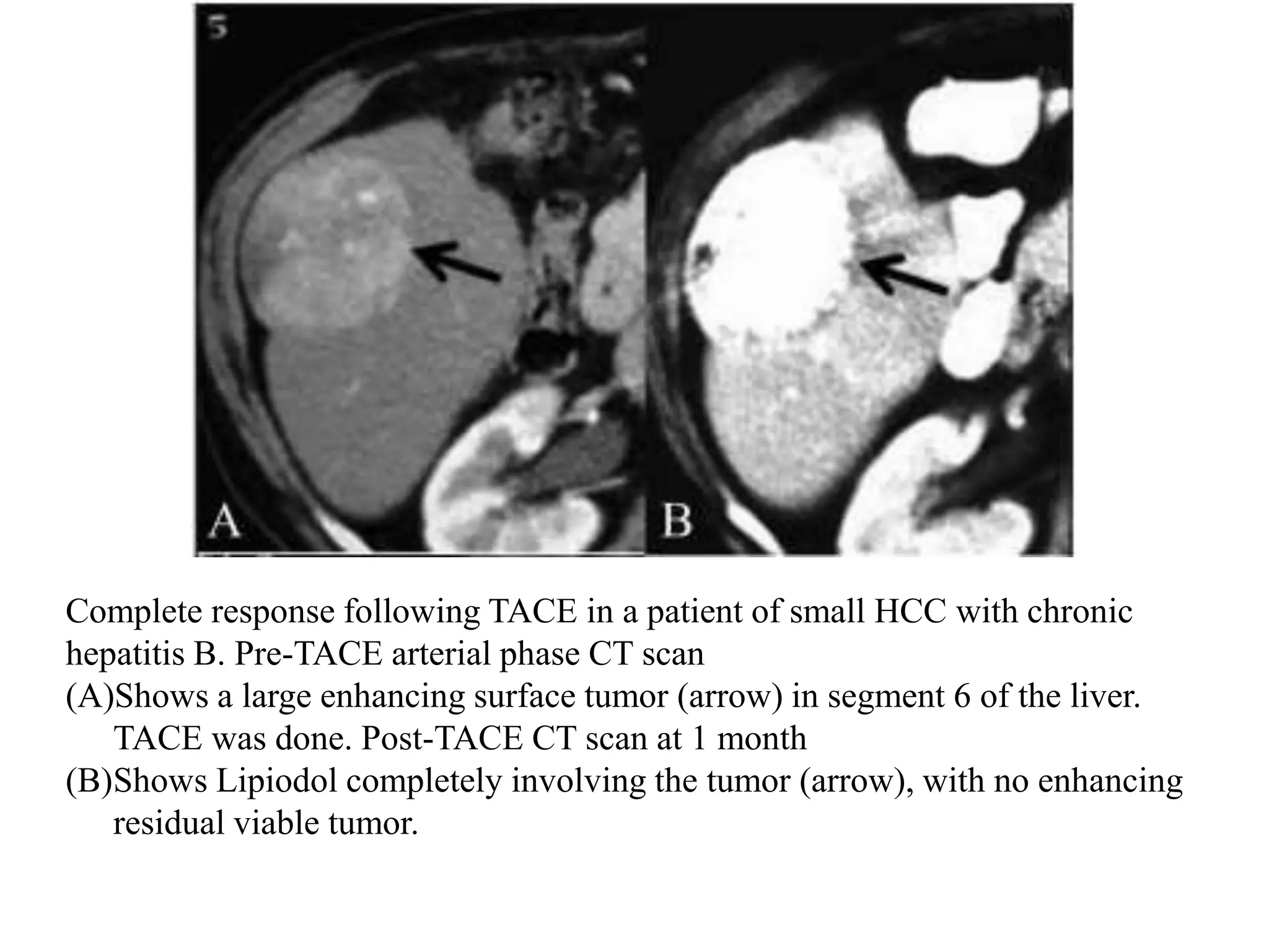 TACE- Transarterial Chemoembolisation | PPTX