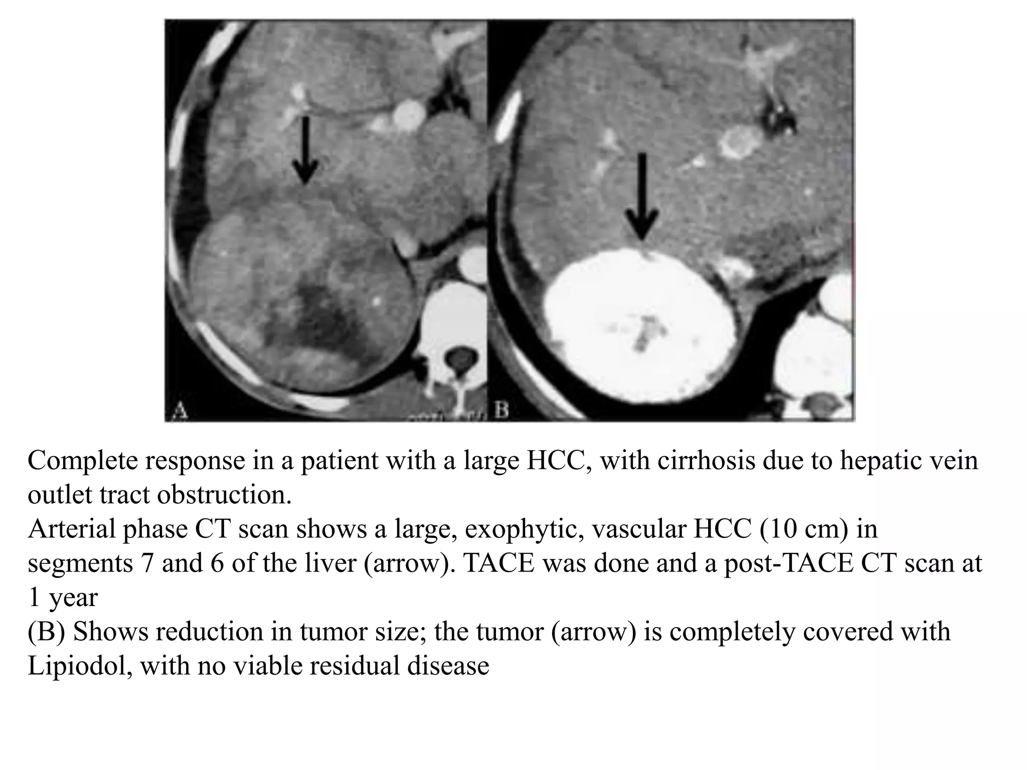 TACE- Transarterial Chemoembolisation | PPTX