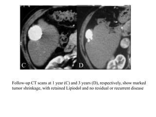 TACE- Transarterial Chemoembolisation | PPTX