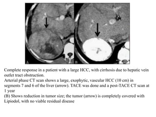 TACE- Transarterial Chemoembolisation | PPTX