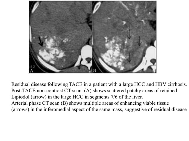 TACE- Transarterial Chemoembolisation | PPTX