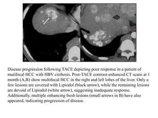 TACE- Transarterial Chemoembolisation | PPTX