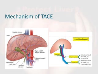 TACE- As a management option of HCC.pptx