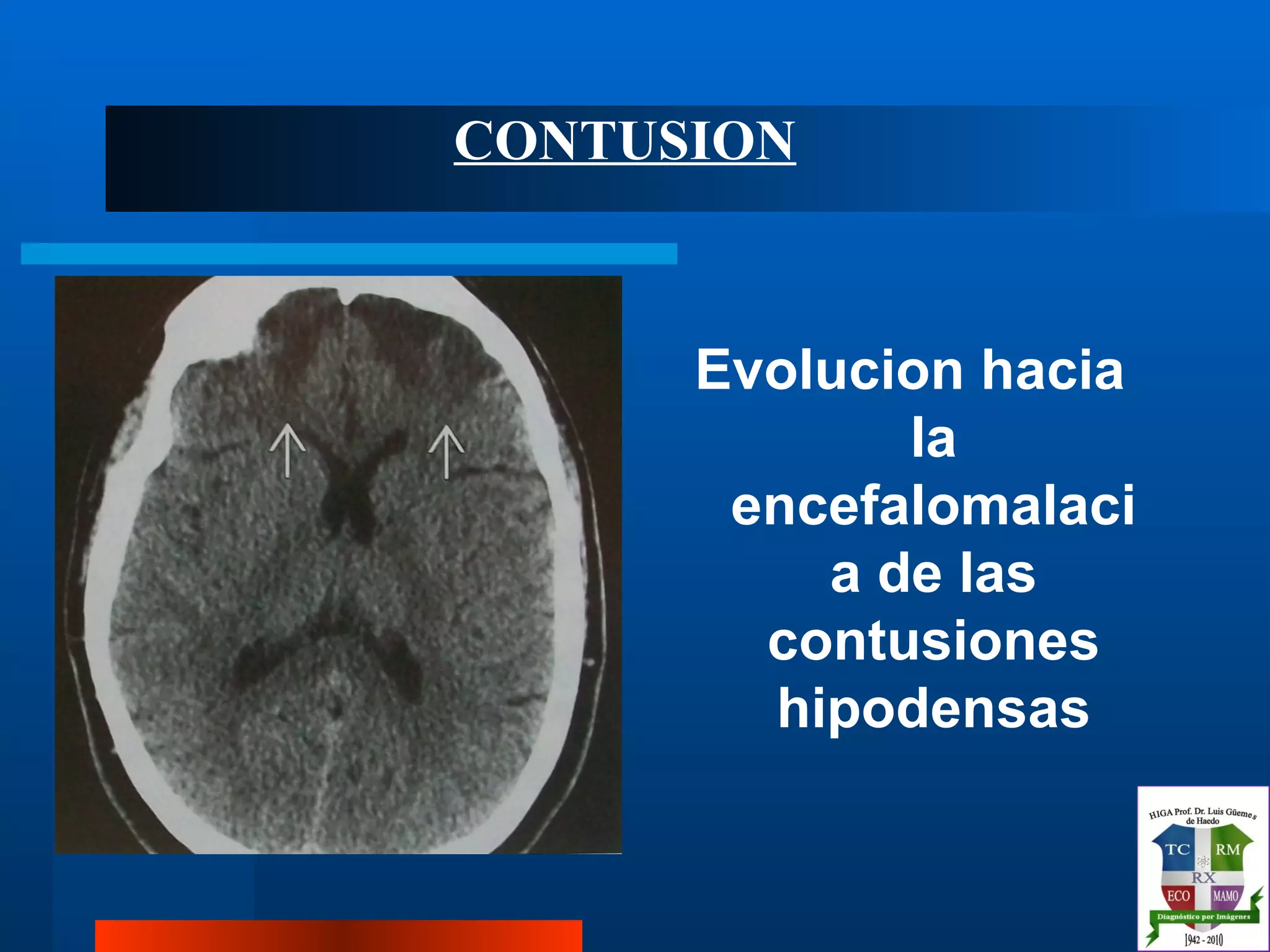 Tac en trauma de encefalo | PPT