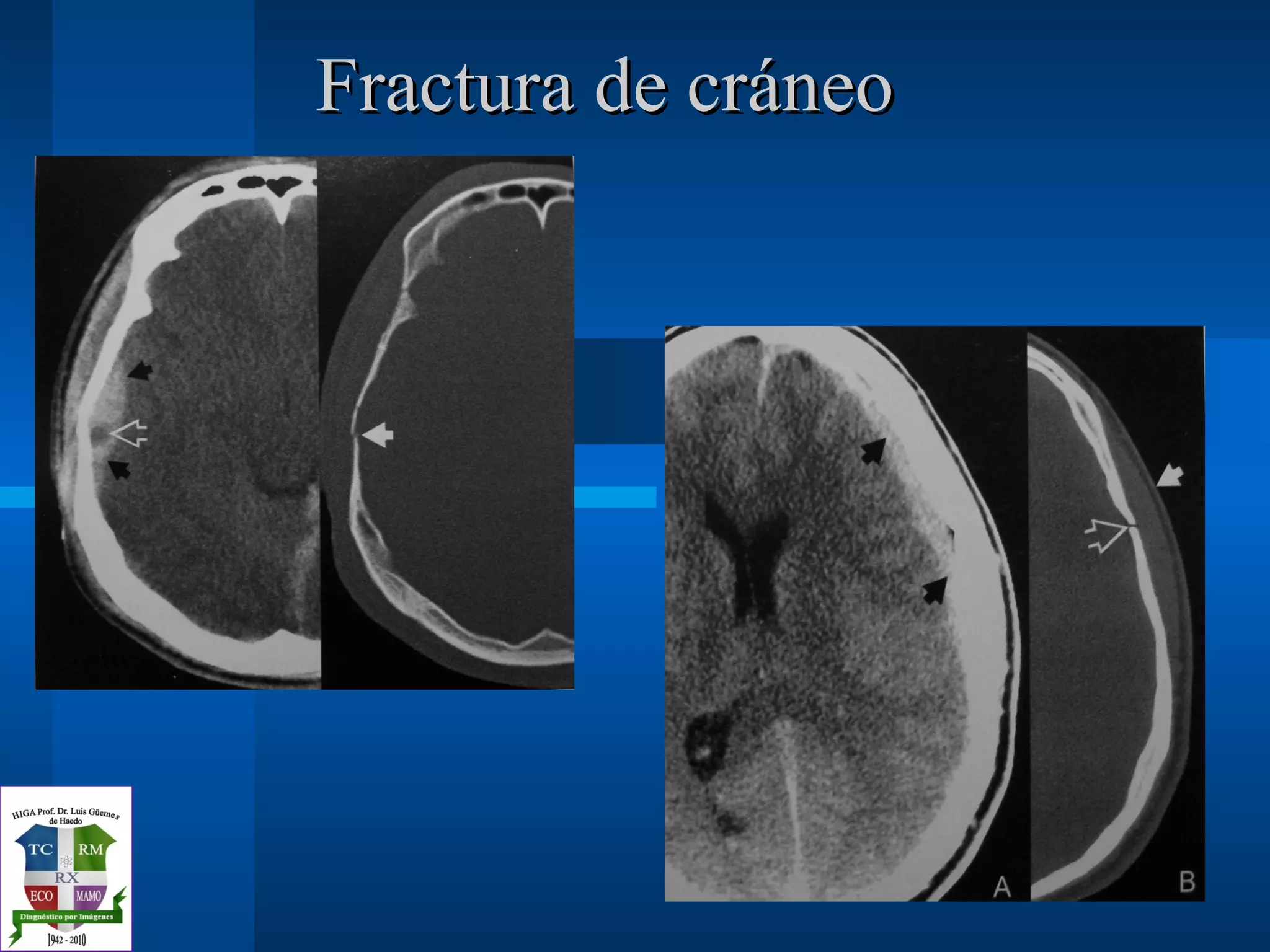 Tac en trauma de encefalo | PPT