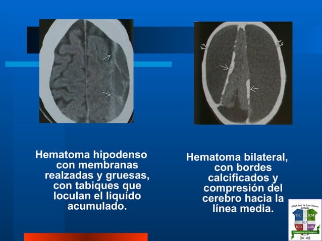 Tac en trauma de encefalo | PPT