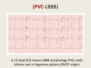 Arrhythmia-Induced Cardiomyopathies | PPTX