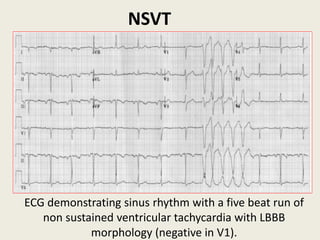 Arrhythmia-Induced Cardiomyopathies | PPTX