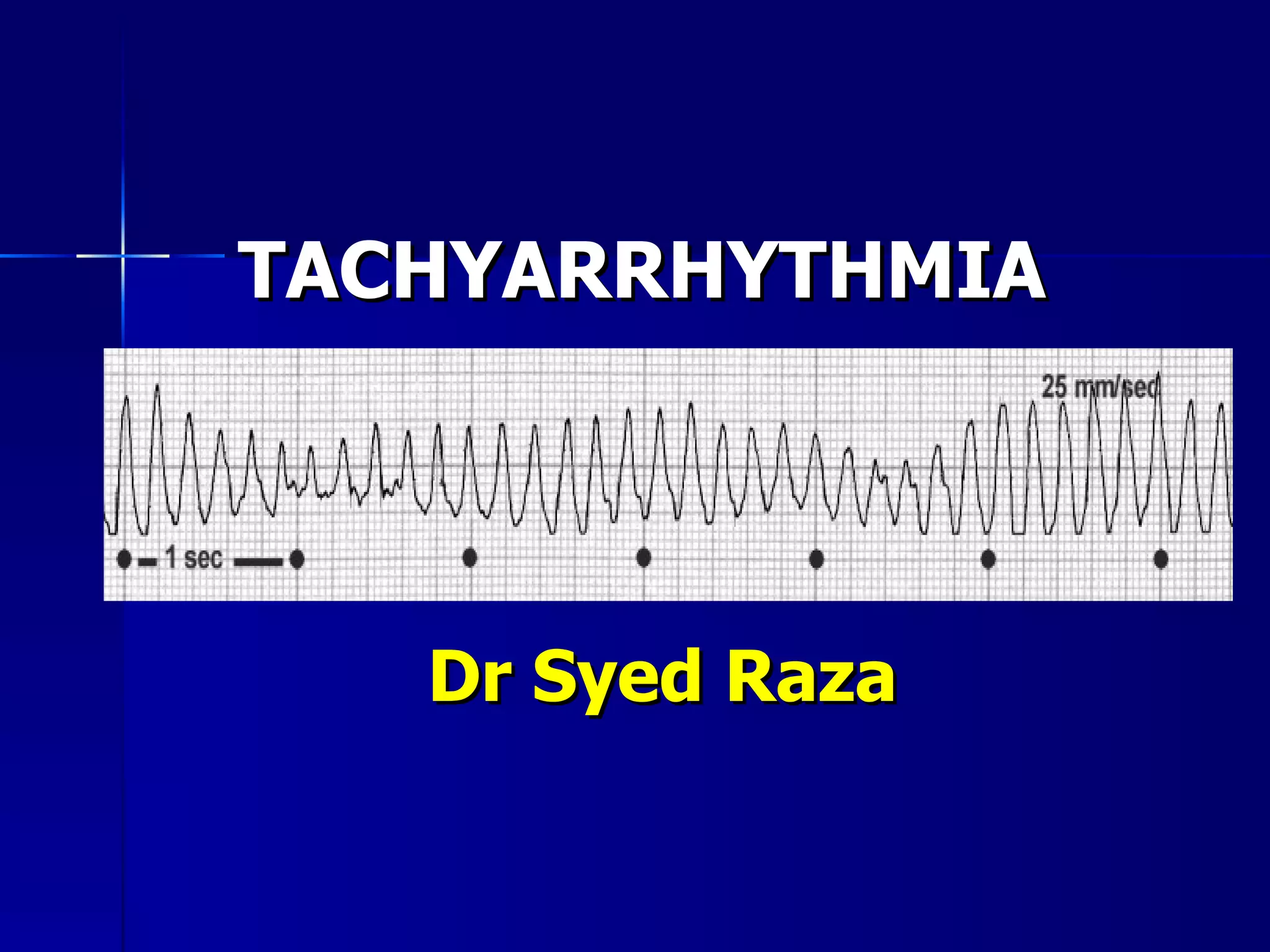 Tachyarrhythmia | PPT