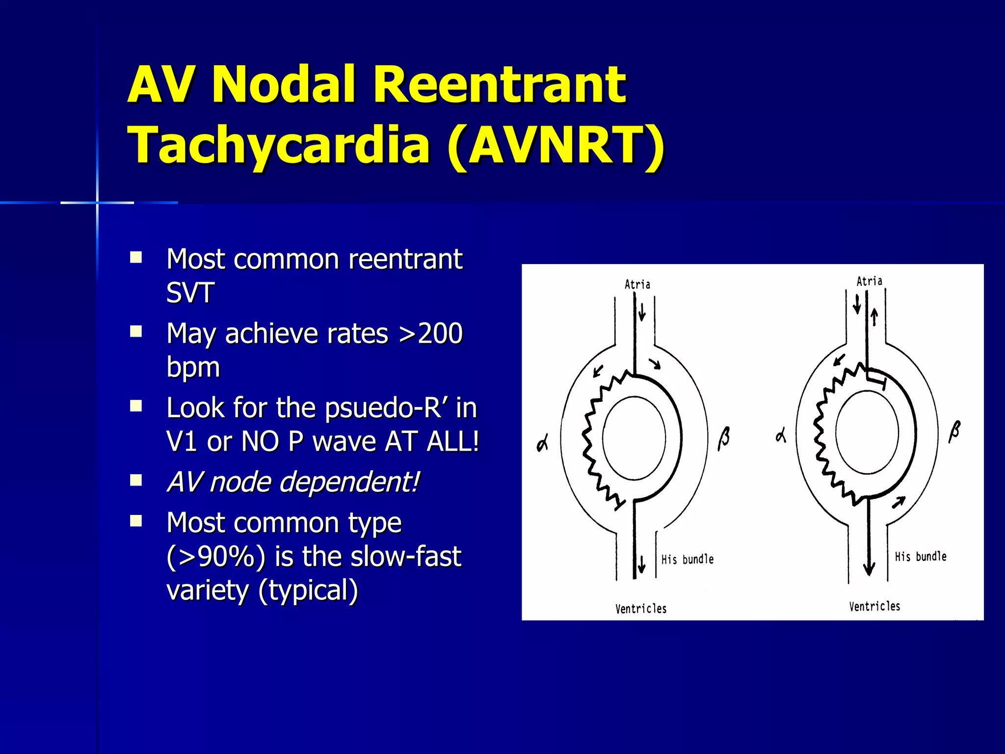 Tachyarrhythmia | PPT