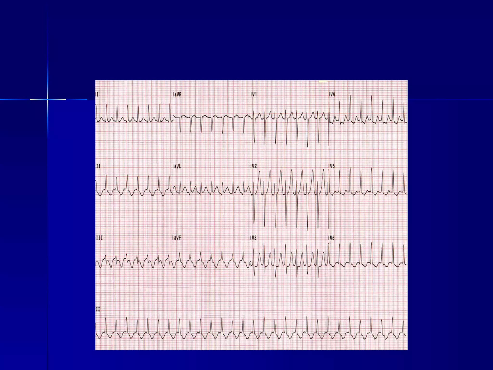 Tachyarrhythmia | PPT