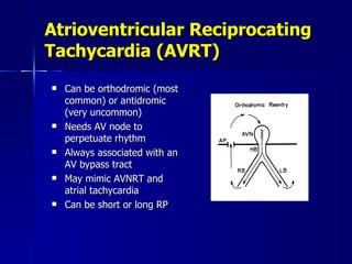 Tachyarrhythmia | PPT