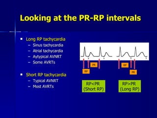 Tachyarrhythmia | PPT
