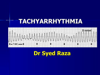 TACHYARRHYTHMIA | PPT