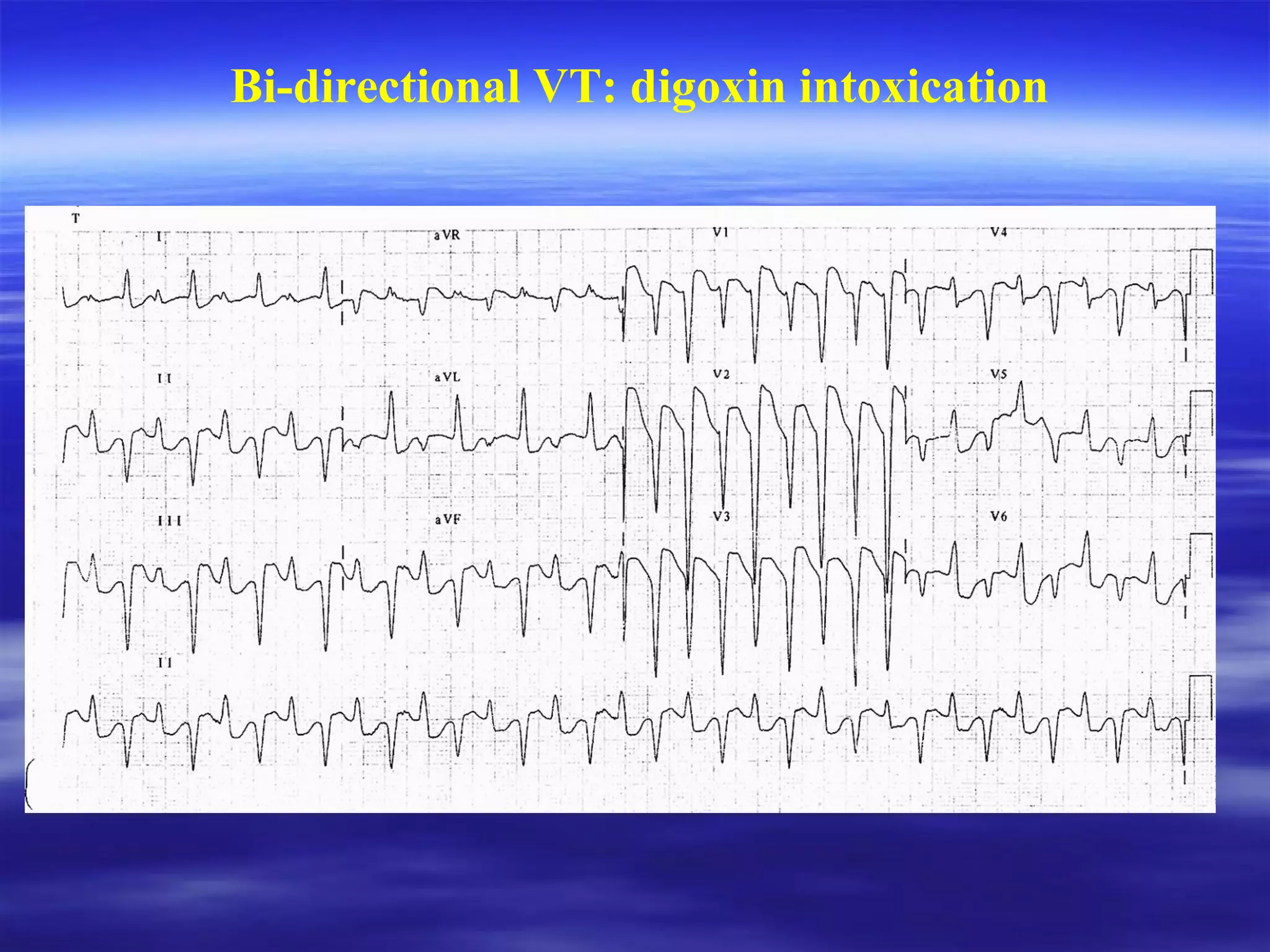 Arrhythmia: ECG--- Tachycardia_20120902_北區 | PPT