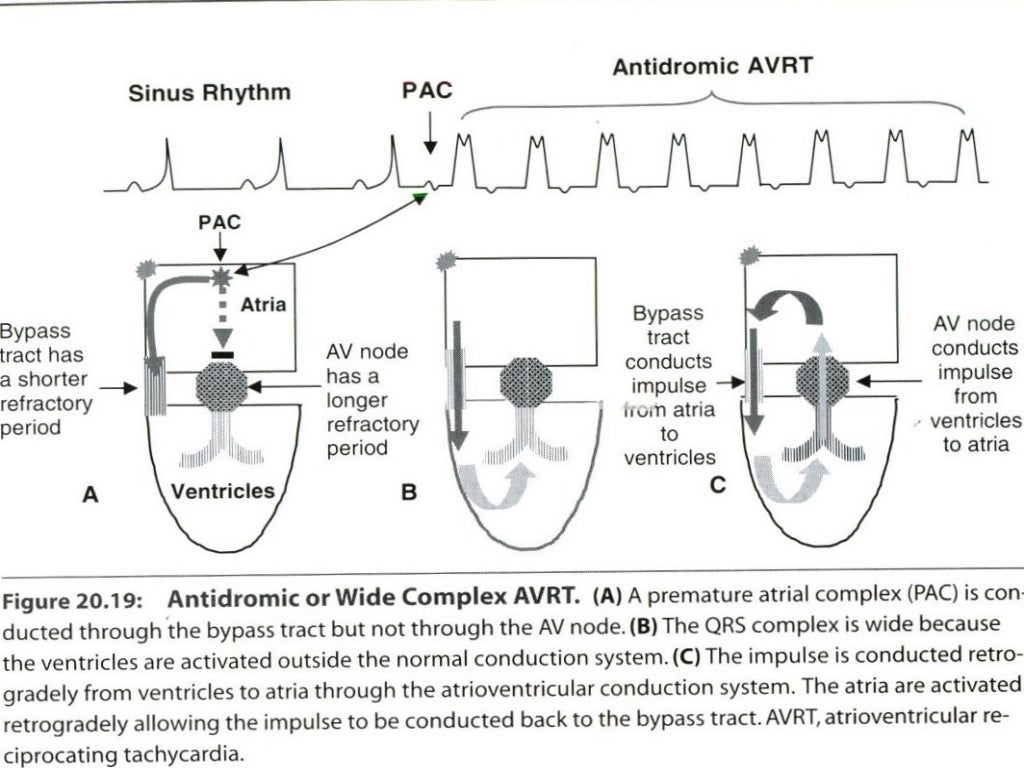 Tachyarrhythmias