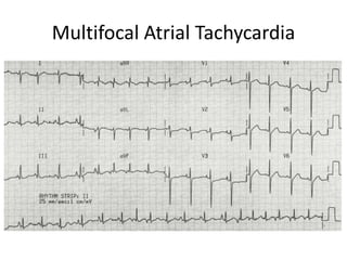 Tachyarrhythmias | PPT