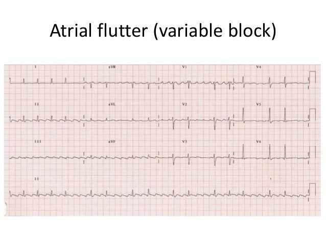Tachyarrhythmias