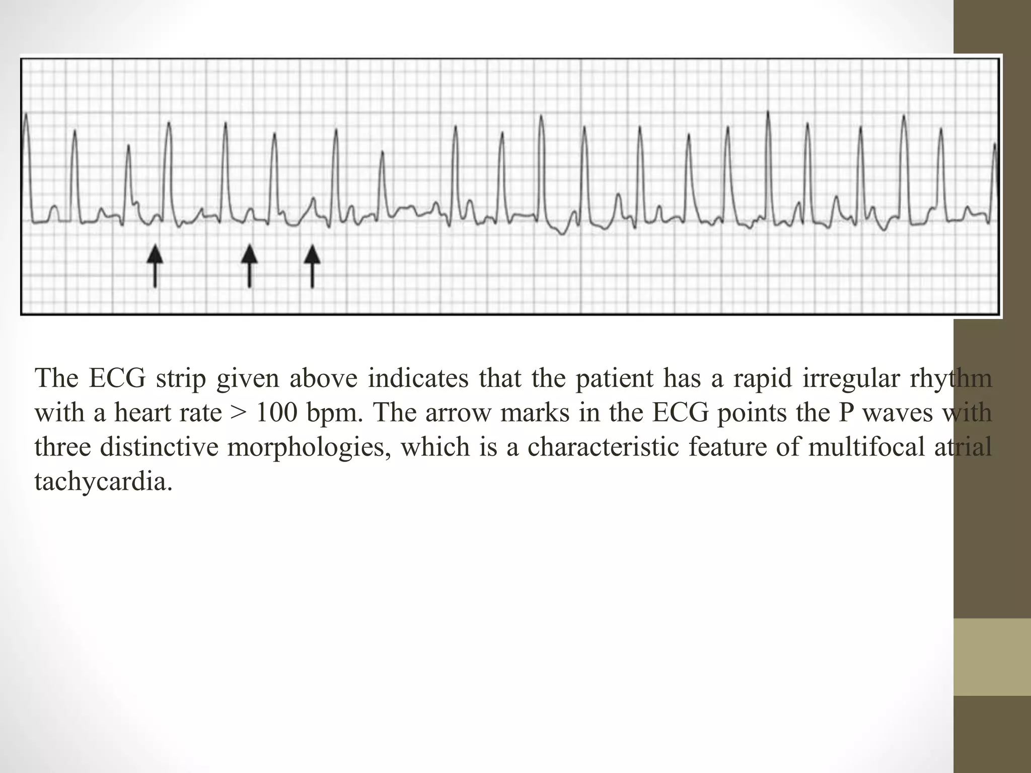 Tachyarrhythmias | PPTX