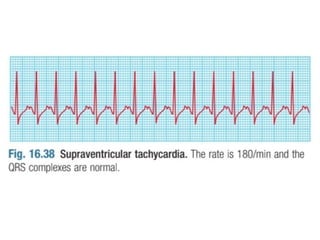 PRESENTATION ON tachyarrhythmias AND ETIOLOGY | PPT