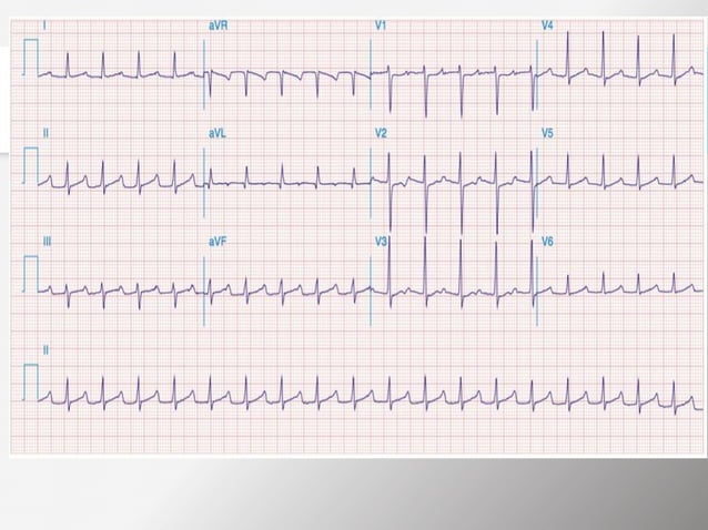Tachy Arrhythmias - Approach to Management | PPTX