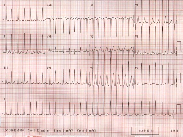Tachy Arrhythmias - Approach to Management | PPTX