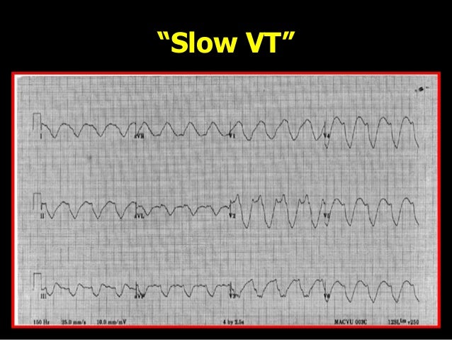 Indiana ENA 2011 Tachyarrhythmias
