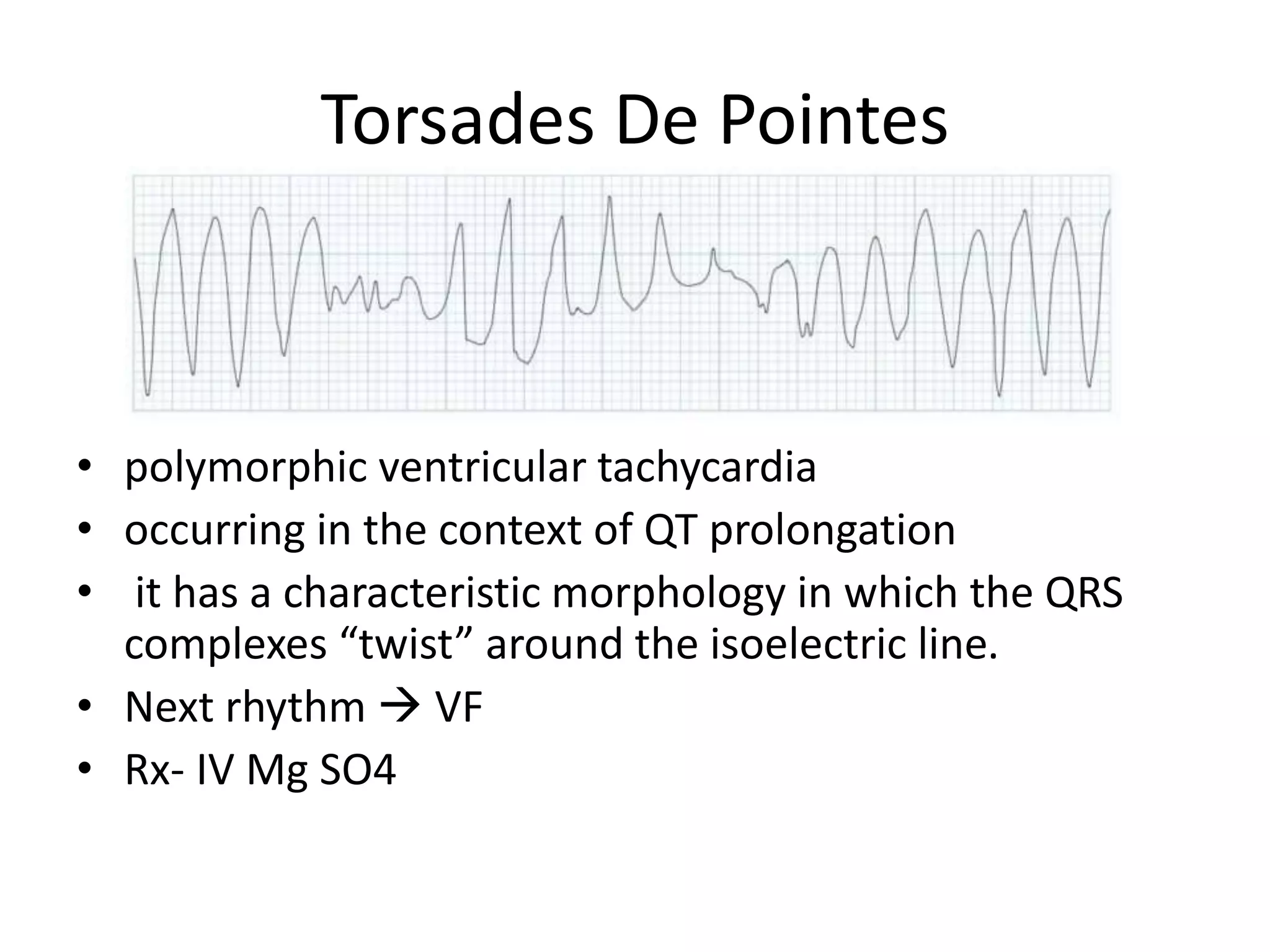 Tachyarrythmia ecg | PPTX