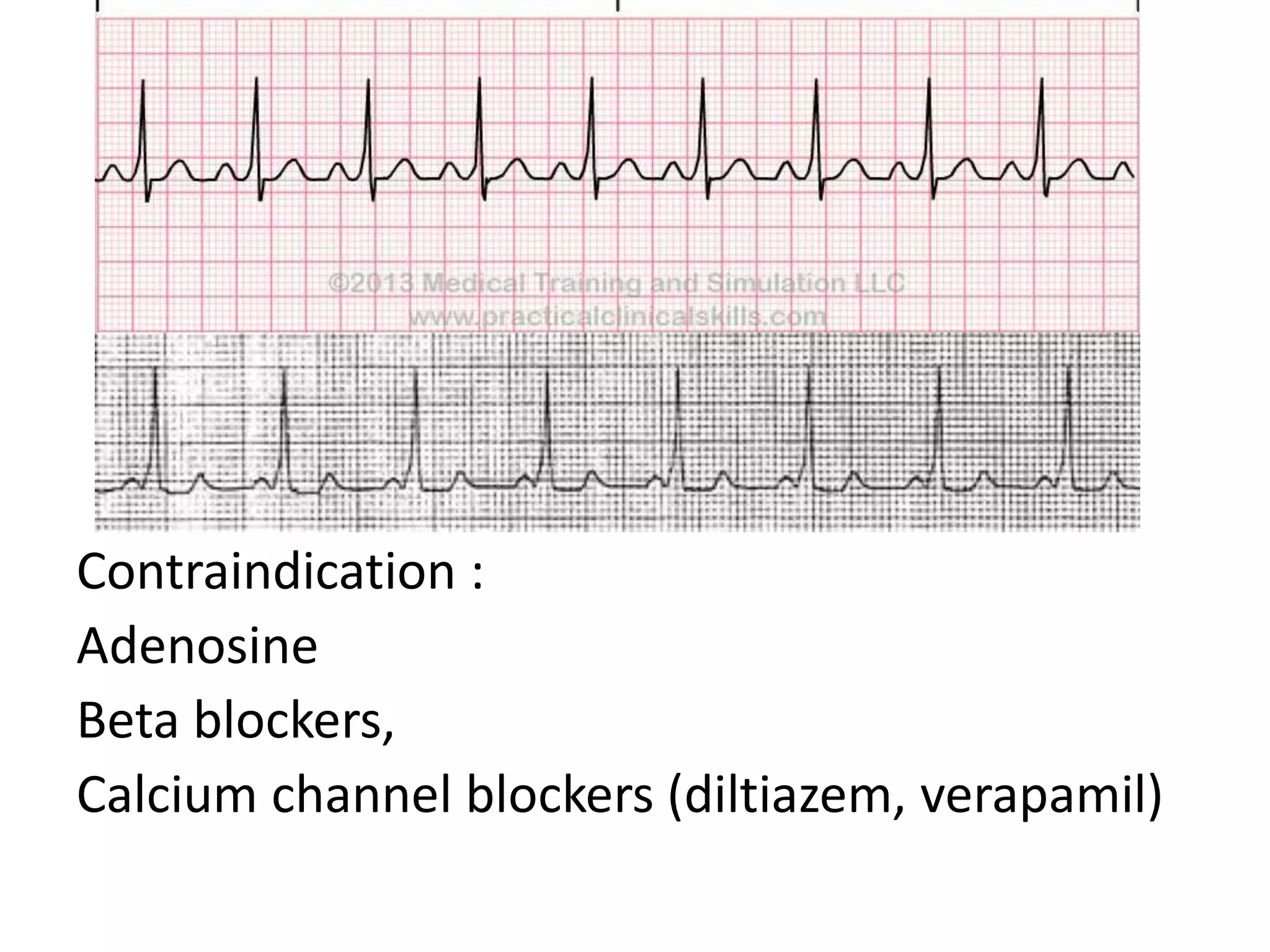 Tachyarrythmia ecg | PPTX