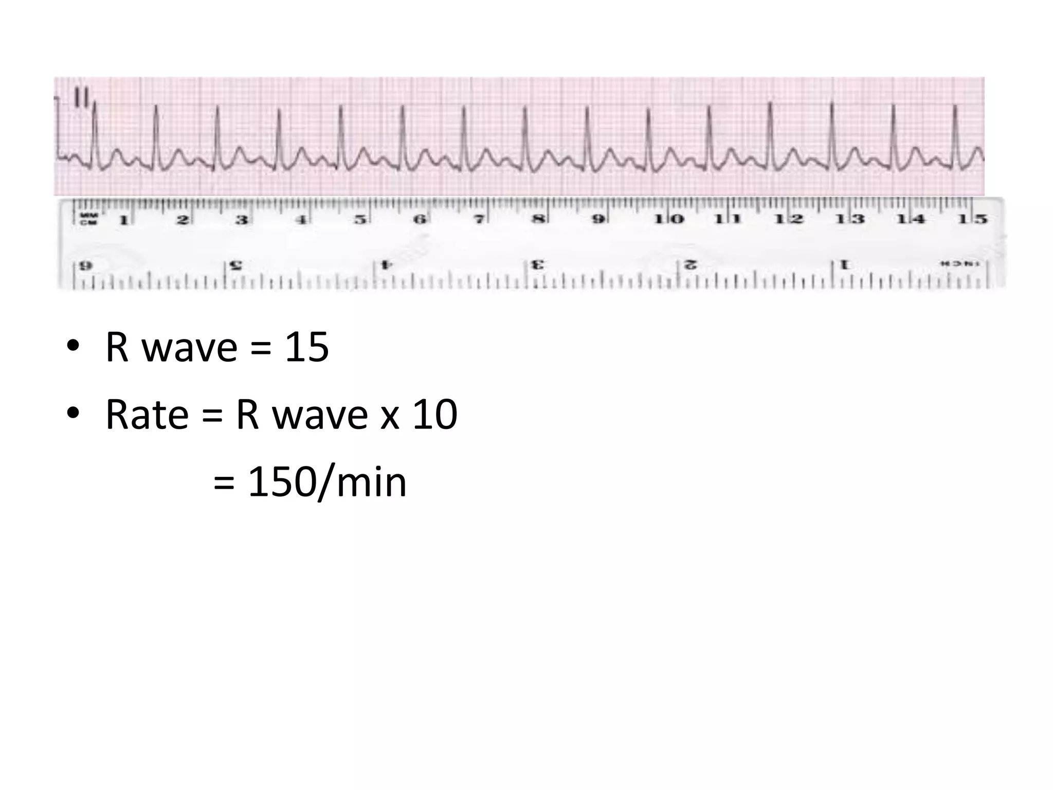 Tachyarrythmia ecg | PPTX