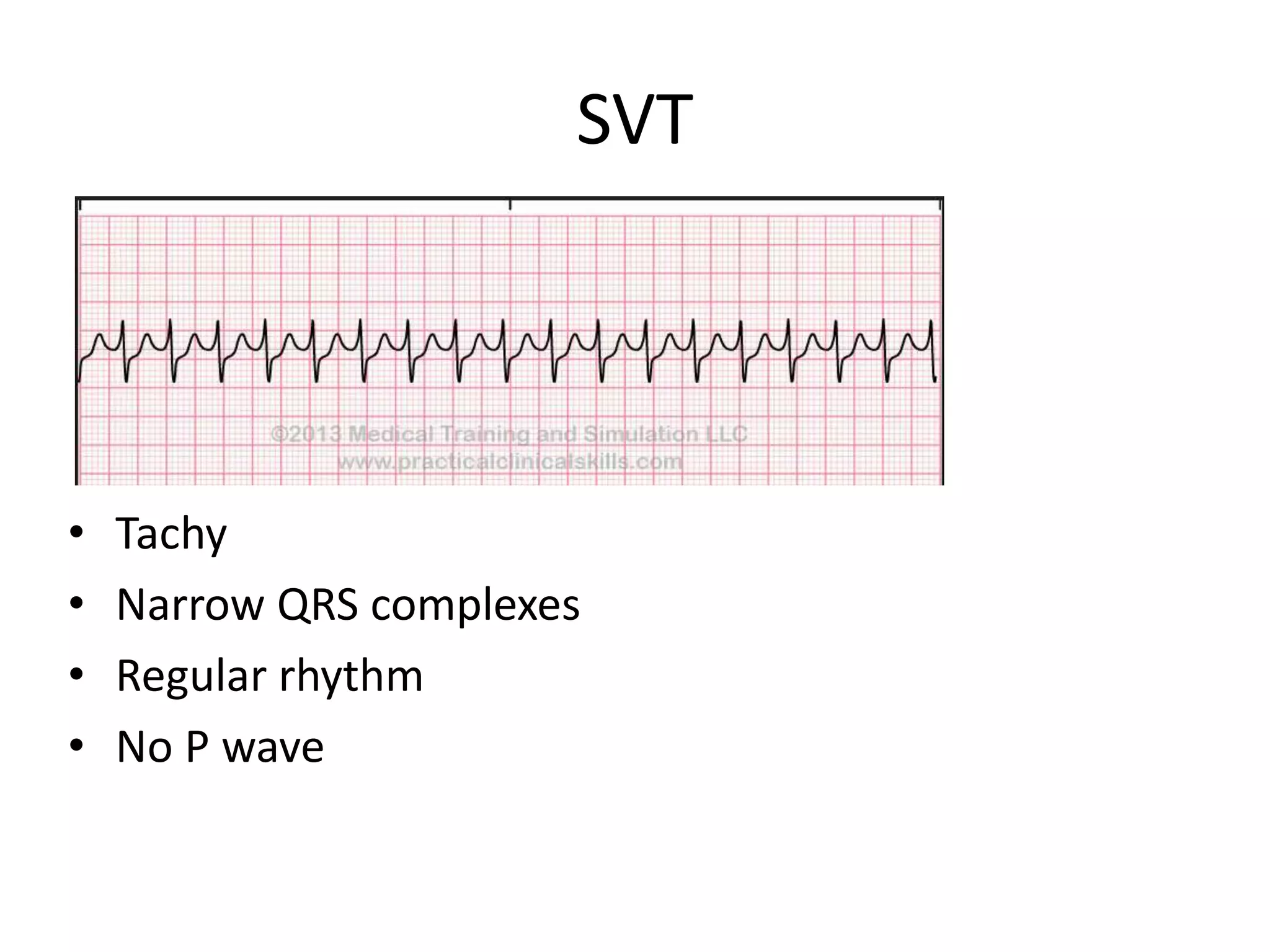 Tachyarrythmia ecg | PPTX