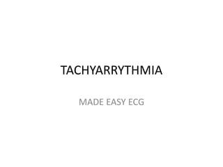 Tachyarrythmia ecg | PPTX
