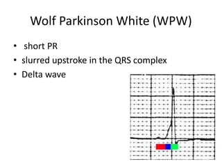 Tachyarrythmia ecg | PPTX