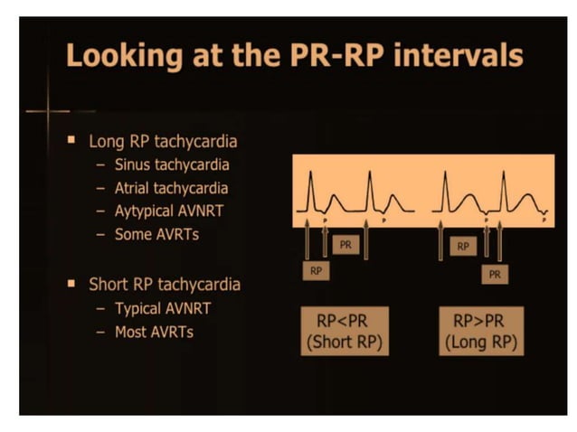 TACHYCARDIA IN ECG ,CAUSES AND MANAGEMENT OF TACHYARRHYTHMIAS | PPTX