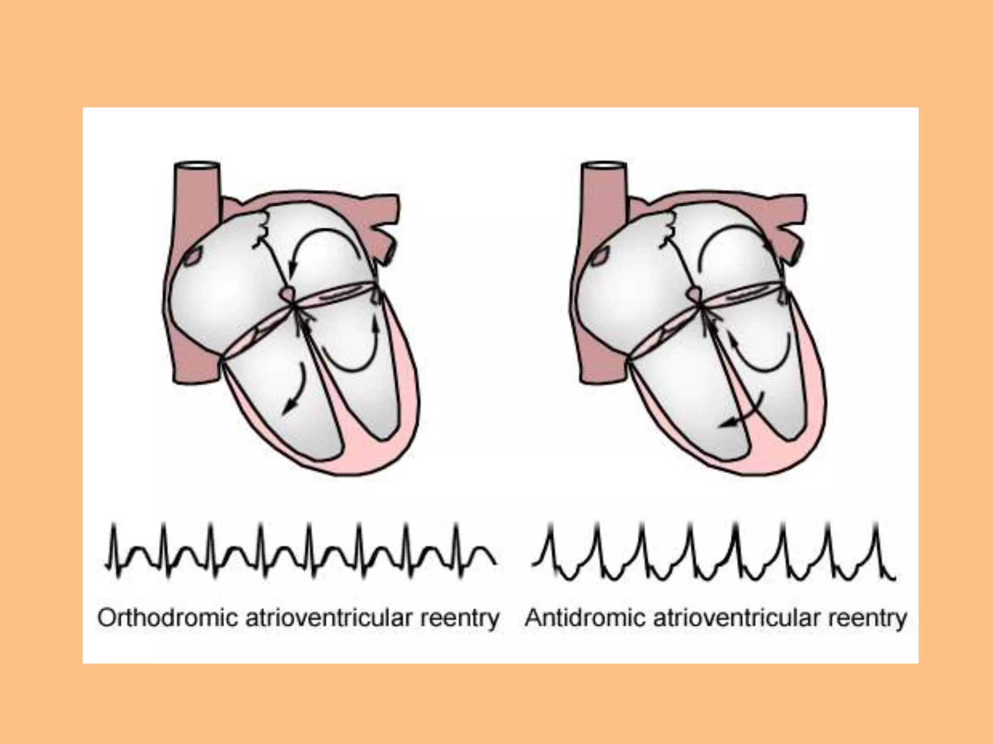 Tachycardias associated with accessory av pathways | PPT