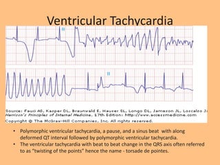 Tachycardias associated with accessory av pathways | PPT