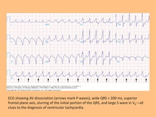 Tachycardias associated with accessory av pathways | PPT
