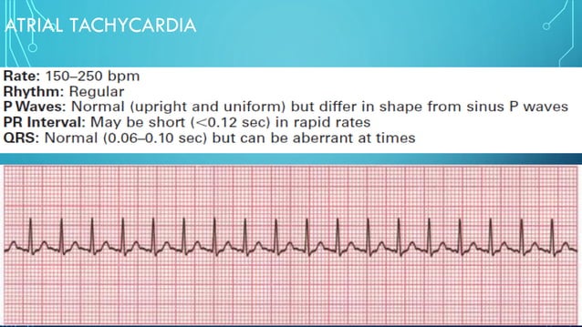 TACHY ARRYTHMIAS | PDF | Heart and Cardiovascular Diseases | Diseases ...