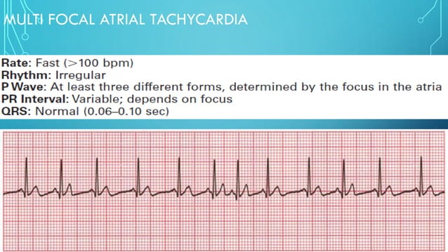 TACHY ARRYTHMIAS | PDF | Heart and Cardiovascular Diseases | Diseases ...