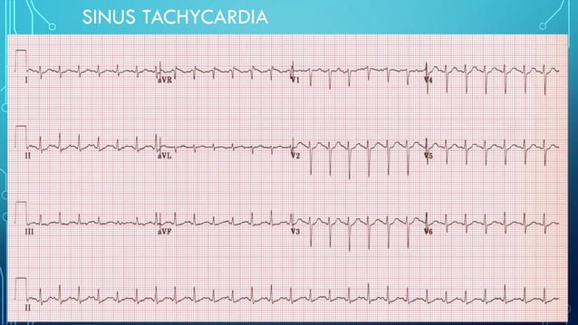 TACHY ARRYTHMIAS | PDF | Heart and Cardiovascular Diseases | Diseases ...