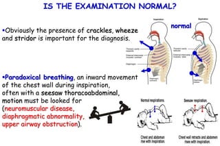 Paradoxical Breathing Pattern