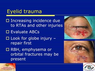 Pearls for Tackling canalicular injuries of Lacrimal Apparatus ...