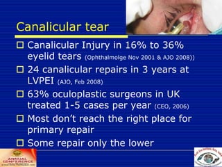 Pearls for Tackling canalicular injuries of Lacrimal Apparatus ...