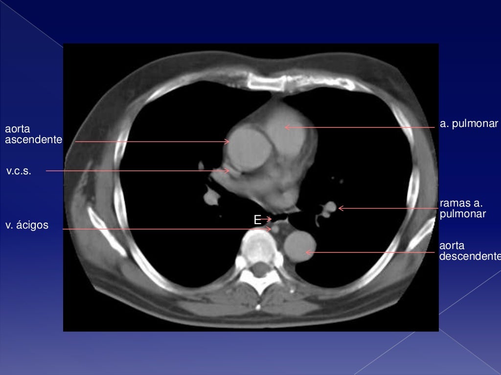 Tac Torax Patron Nodular