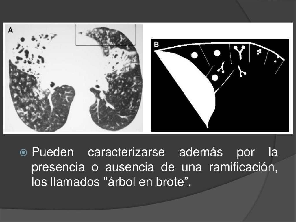Tac Torax Patron Nodular